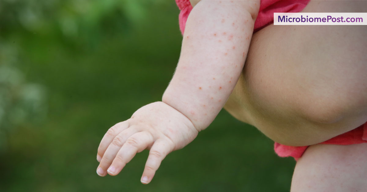 Scientists explore the causal role of gut microbiota in food allergy