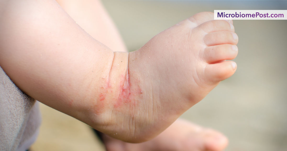 Skin bacteria could help diagnose childhood eczema
