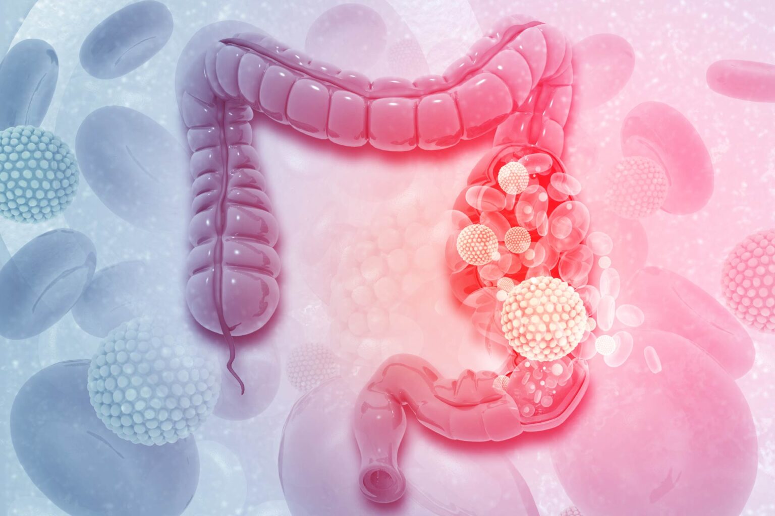 Colorectal cancer: intestinal microbes could protect against inflammation