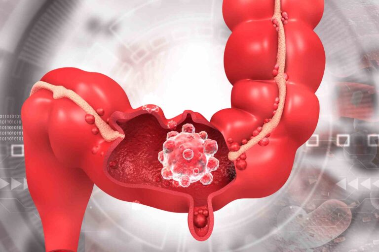 Researchers associate microbial signatures with two types of ...