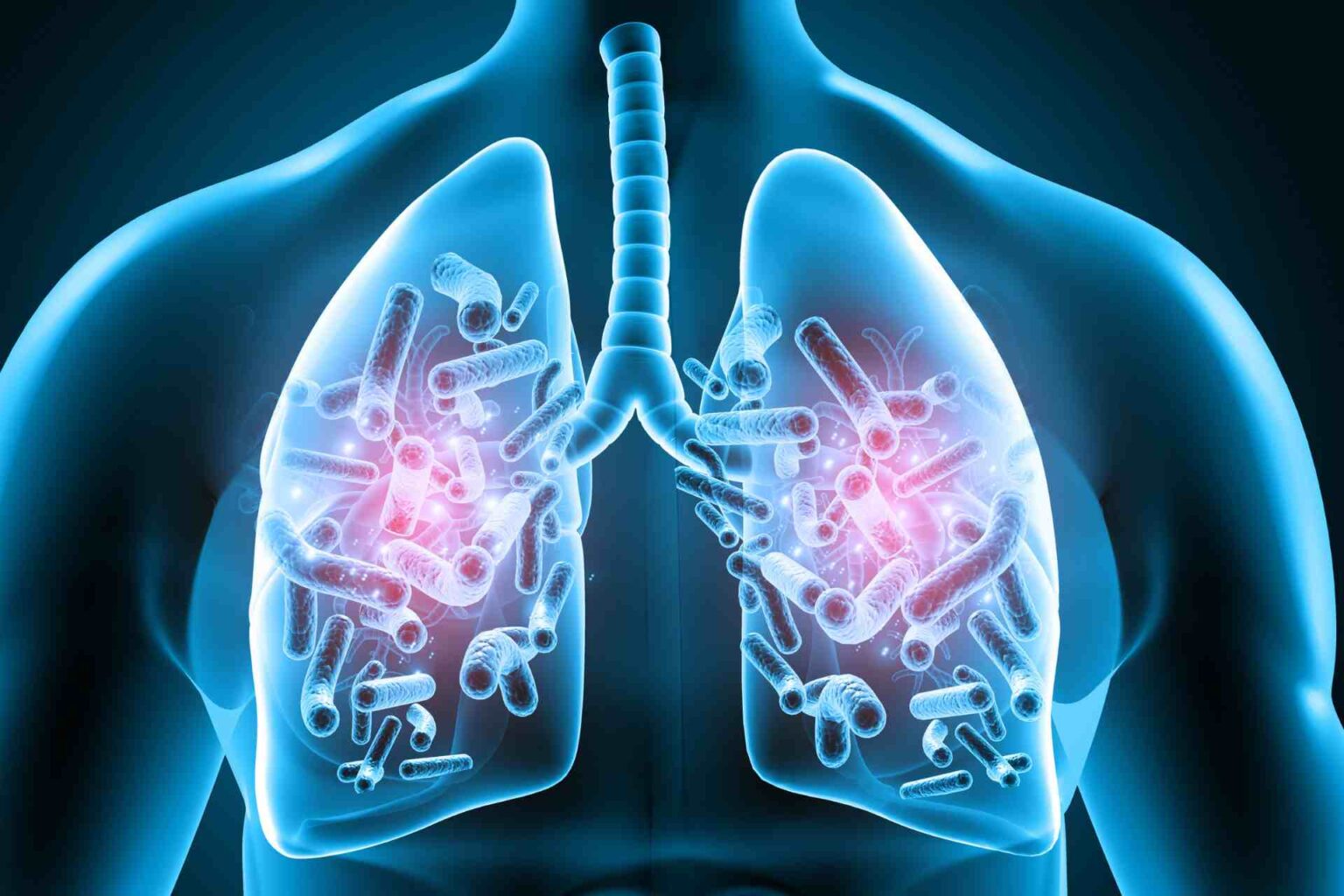 The respiratory microbiota could contribute to determine the severity ...