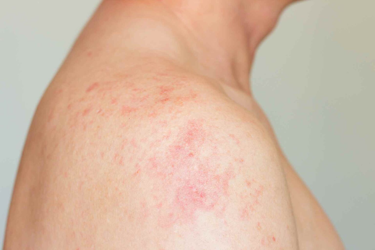 Insights into Indigenous skin microbiotas offer clues to fungal ...